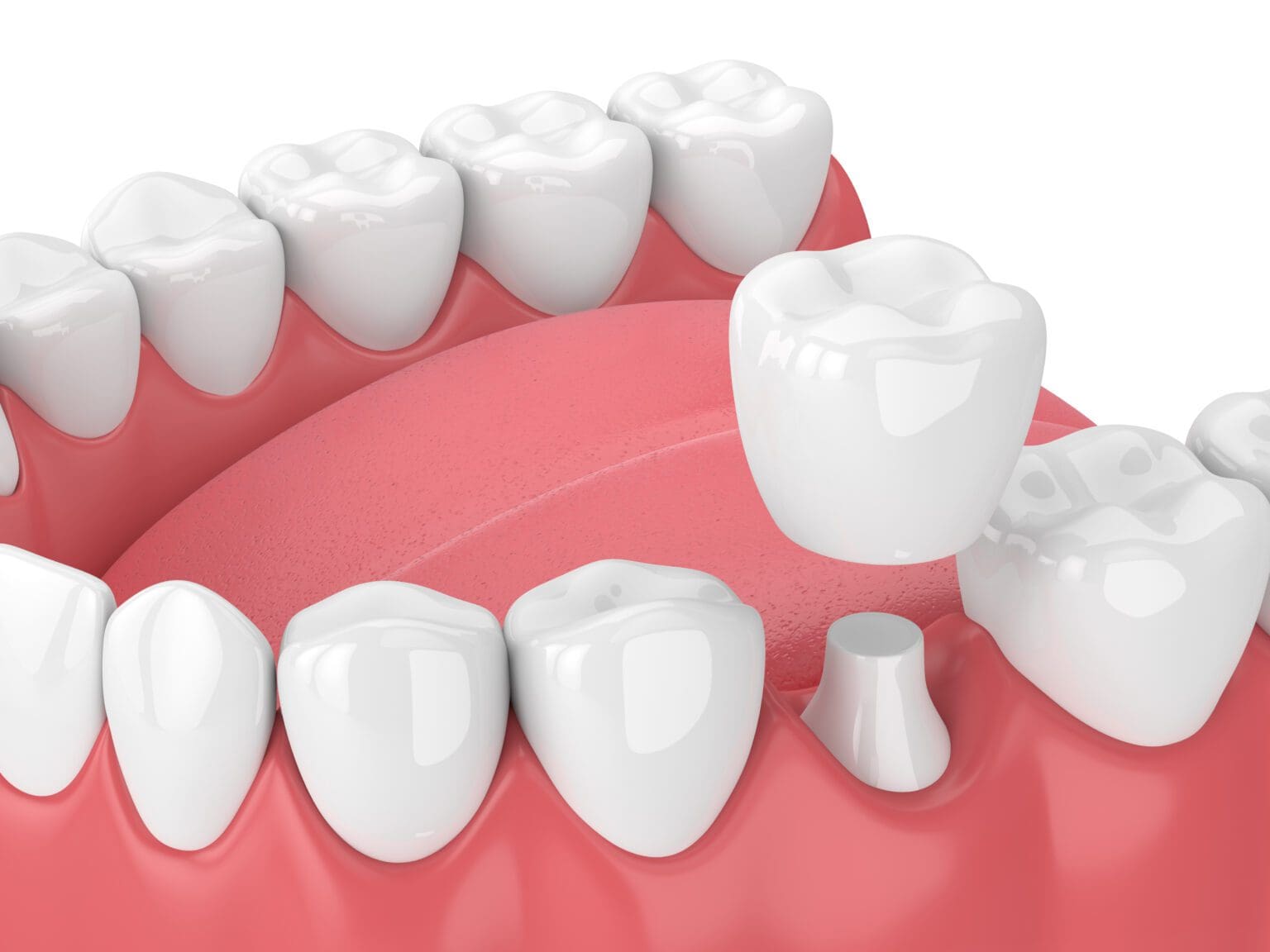 Understanding the Cost of Dental Crown: A Comprehensive Overview